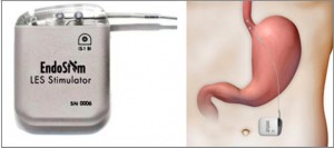 GERD-Treatment EndoStim is Liquidated – The World of Implantable Devices