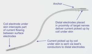 Bioness’ StimRouter Implantable Neurostimulator Reroutes TENS Pulses ...