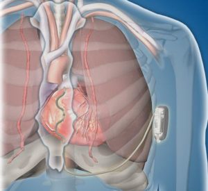 Medtronic’s Extravascular Implantable Cardioverter Defibrillator (EV ...
